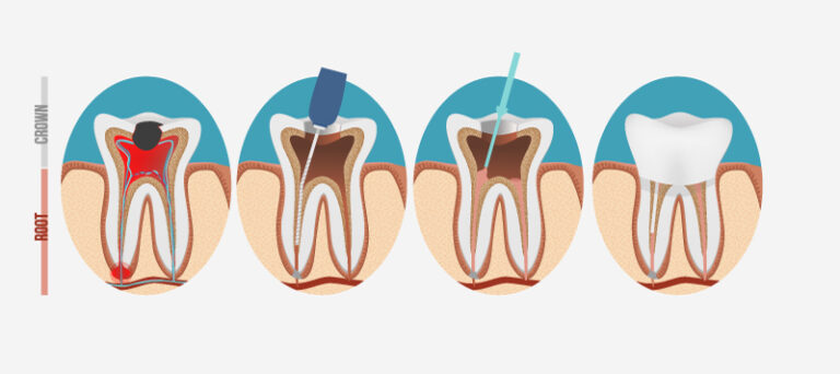 Root Canal Treatment | RCT Crown And Bridge